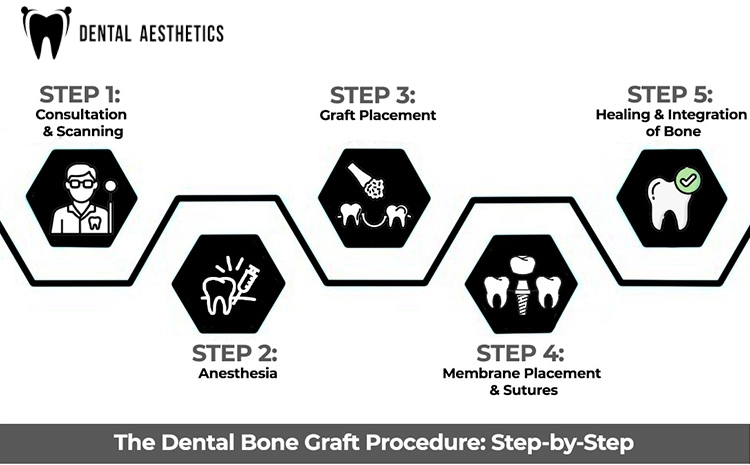 Dental Bone Graft: Procedure, Benefits & Recovery Explained